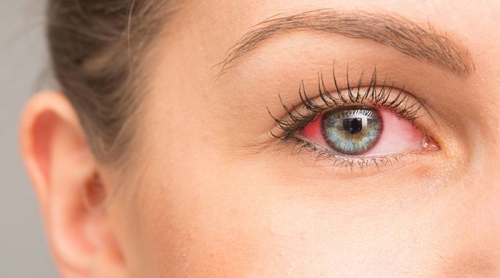 Conjuntivite alérgica | Rejane Casagrande